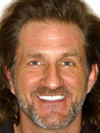 Smile Gallery | Before & After Photos | Dr. Ken Siegel | Blue Bell